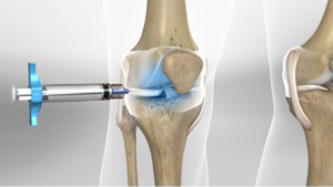 Knee Injection Procedure. Knee Injection Sites
