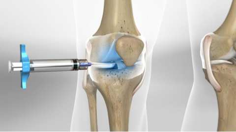Knee Injection Procedure. Knee Injection Sites